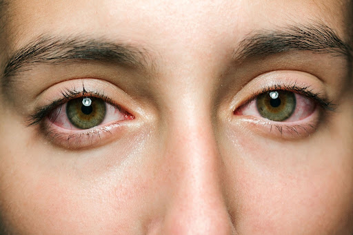 Why Does Cannabis Make Your Eyes Red? | The Cannigma